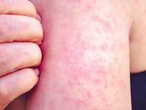 Boutons remplis de sang : causes et traitement - Index Site